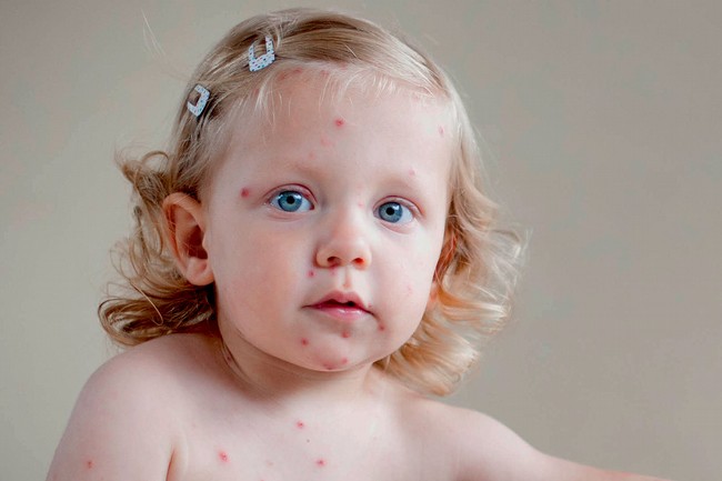 Šire se morbile | Dečji sajt